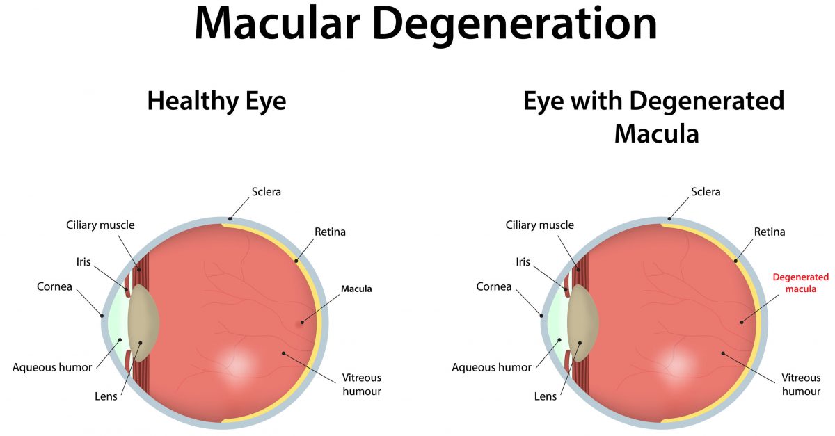 Cataract Surgery and Macular Degeneration - CataractEye.com Cataract Surgery and Macular Degeneration - CataractEye.com