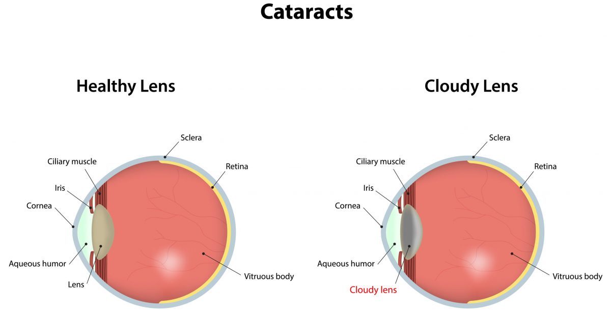 Cataracts - CataractEye.com